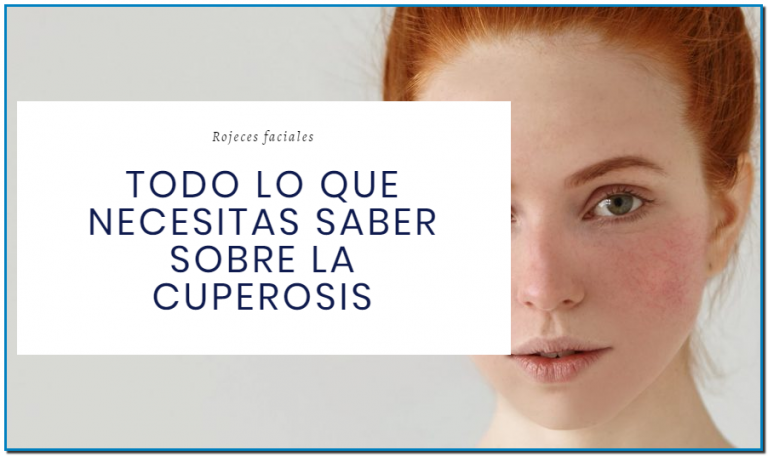 Existen varios factores por los que la cuperosis podría aparecer en tu ...